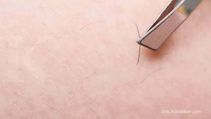 Kenali Ingrown Hair, Salah Satu Penyebab Munculnya Chicken Skin pada Kulit!